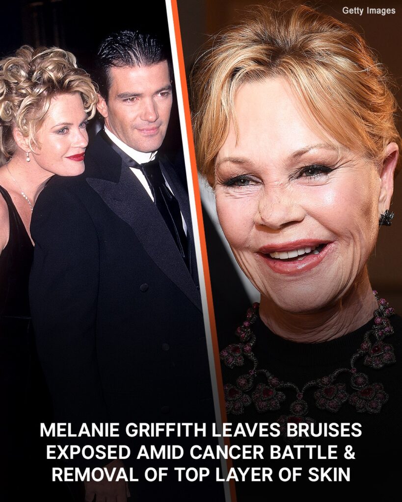Melanie Griffith Leaves Bruises Exposed amid Cancer Battle & Removal of ...
